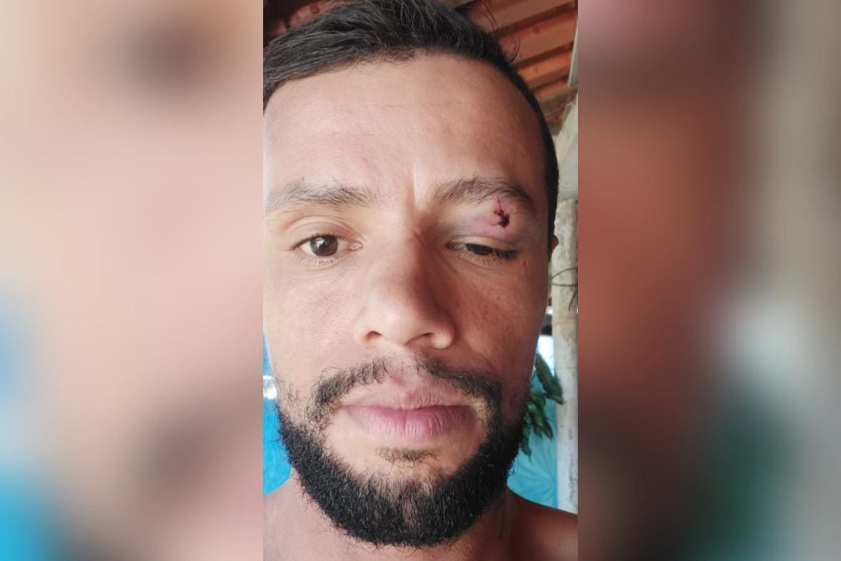 Gari Quase Fica Cego Após Acidente Com Barra De Ferro Em Brumadinho O